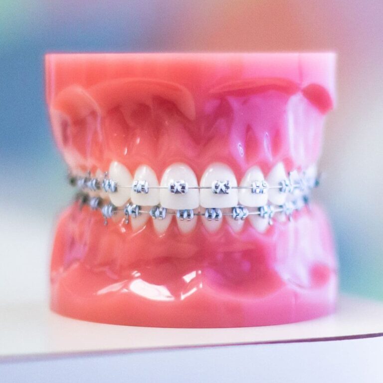 3D-Printed Clear Braces | Christopher Orthodontics | Walla Walla ...